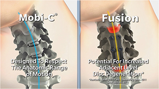 Mobi-C Cervical Artificial Disc Replacement | Beverly Hills, CA